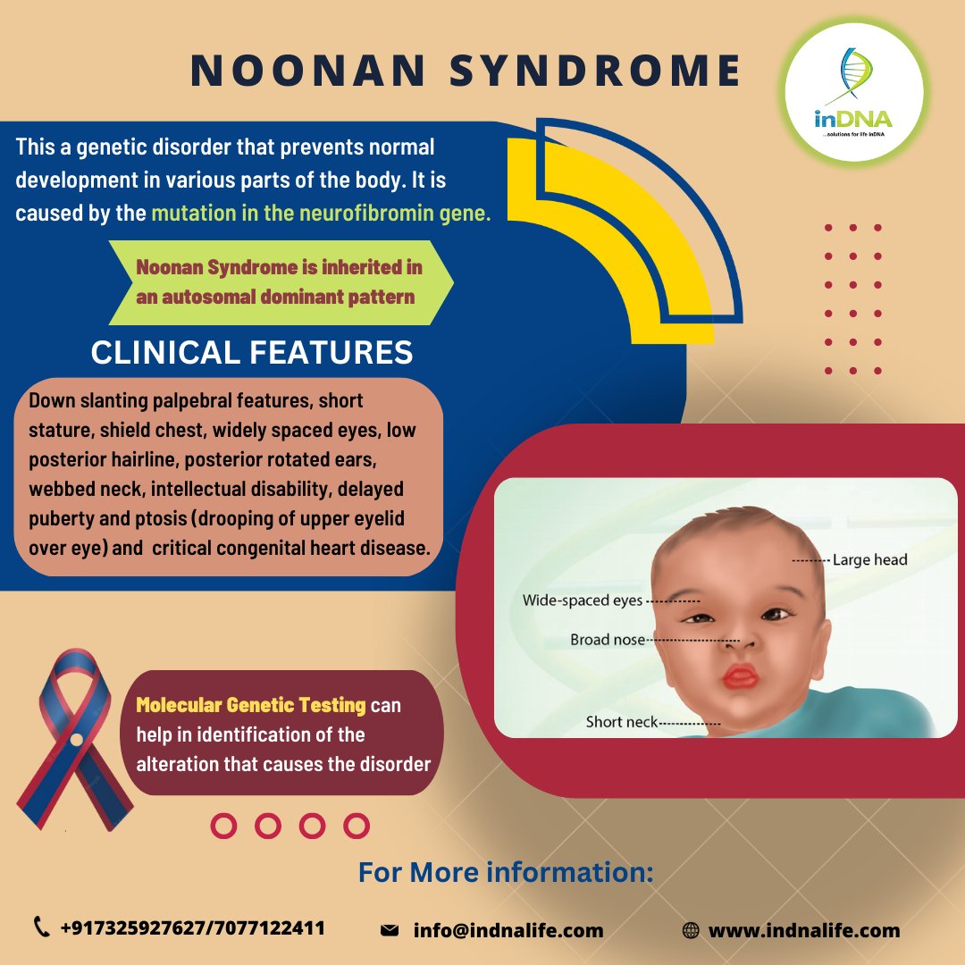 Noonan Syndrome Newborn