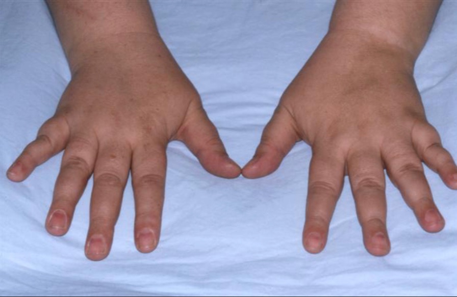 Hyperphosphatemia Skin