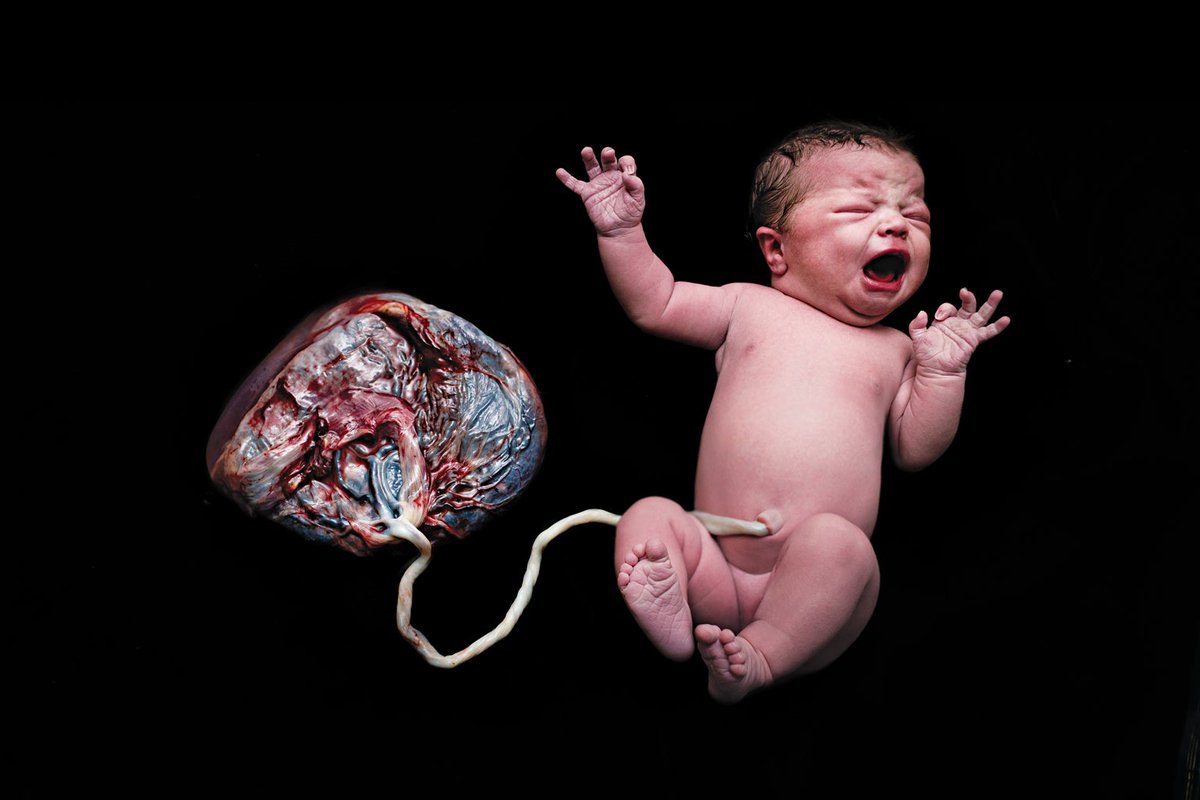 Placenta previa(PP) is a problem of pregnancy in which the placenta ...