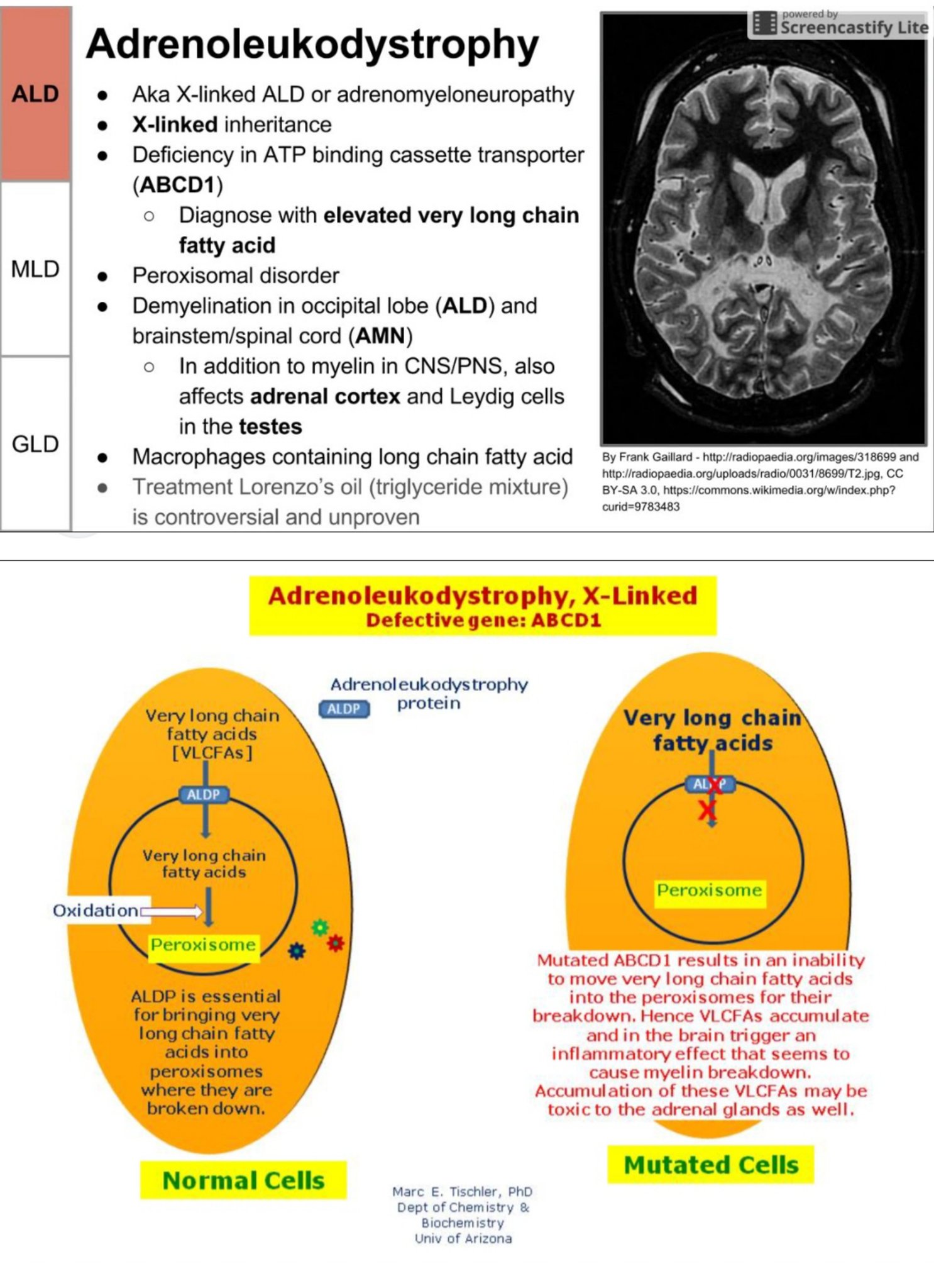 Adrenoleukodystrophy