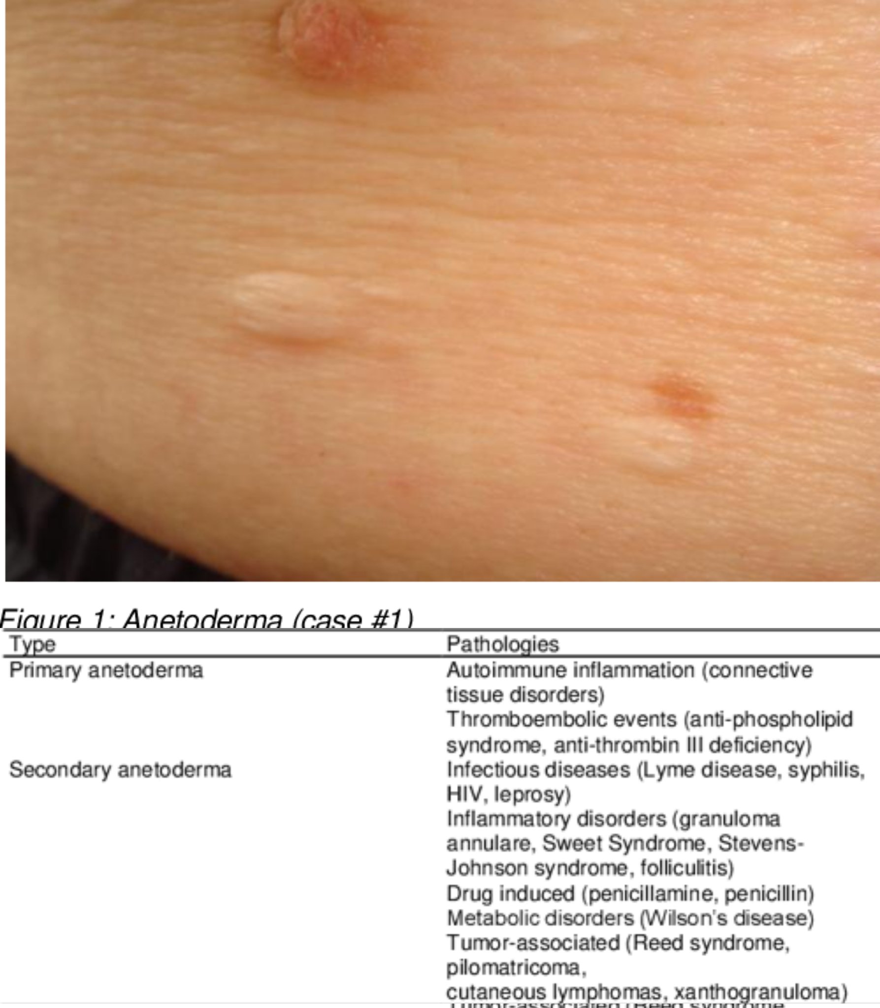Macular Atrophy Skin