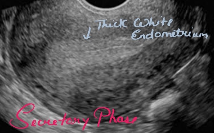 Ultrasound Images Of The Endometrial Cycle Phases Description Of The