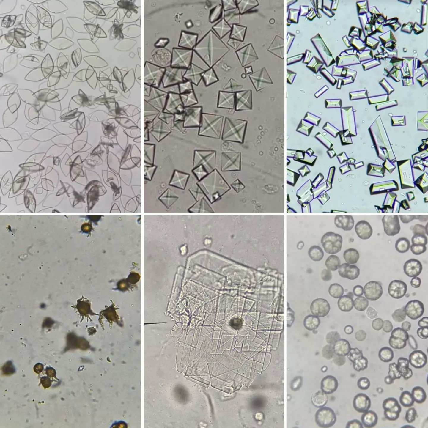 Uratos Amorfos En La Orina | Cristales en la orina en niños: causas ...