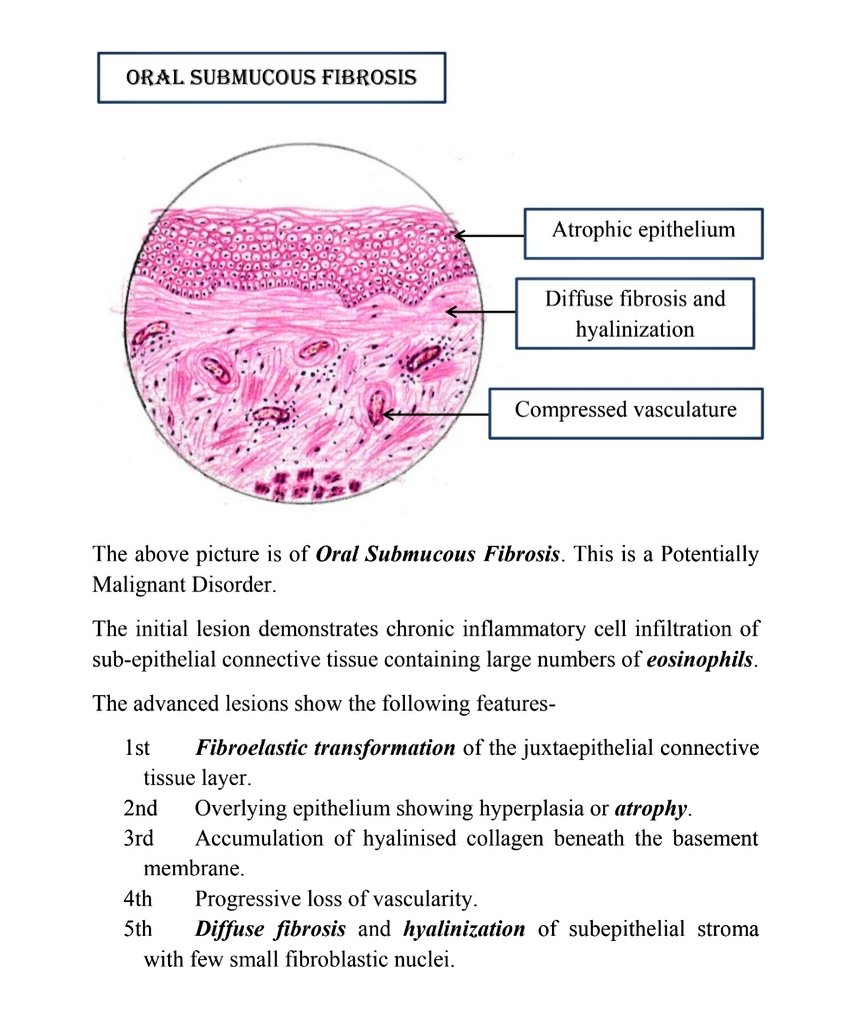 Oral Submucous Fibrosis Histopathology