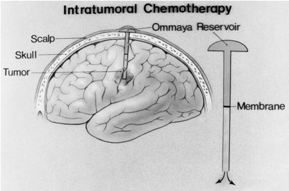 #ثريد Ommaya reservoir - Thread from 3obad__ 😸🚶🏽. @3obad_198 - Rattibha