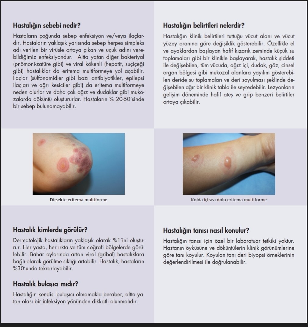 Dr.Hakan Akelma 🩺 on Twitter: "CEVAP: Eritema Multiforme"