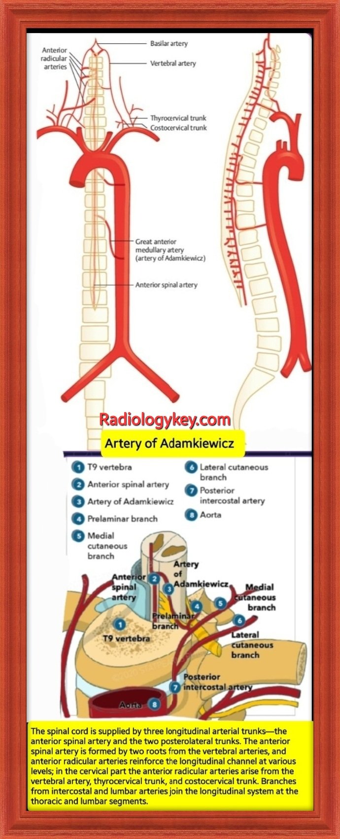 Artery Of Adamkiewicz