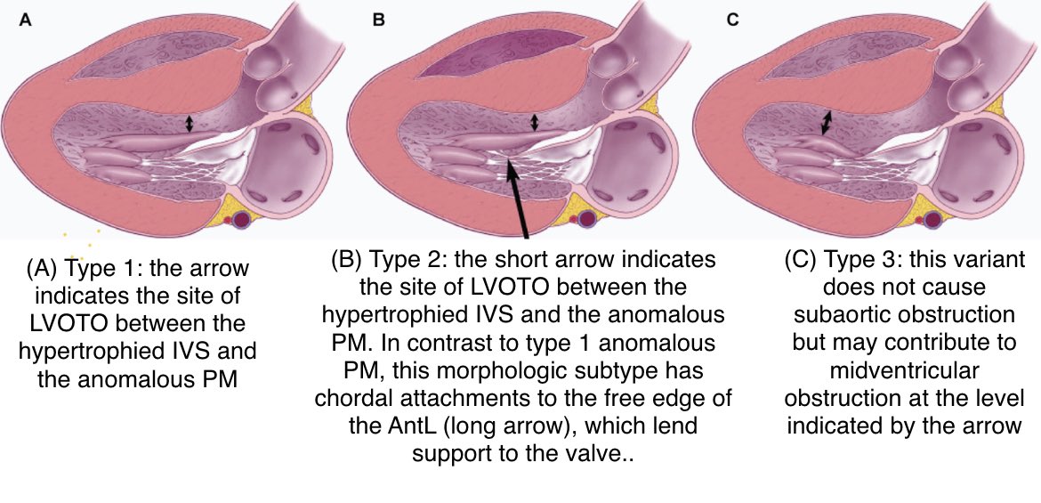 Ritu Thamman MD on Twitter: "@JournalASEcho review of Submitral Apparatus role in HOCM 🫀 ...