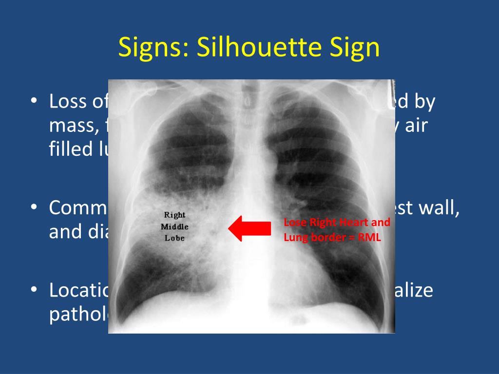 Outlines Of Lung On Cxr