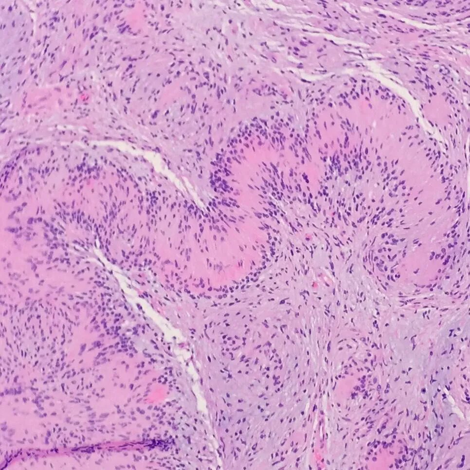 Jerad Gardner, MD on Twitter: "What is this serpiginous structure? Diagnosis? Answers: https ...