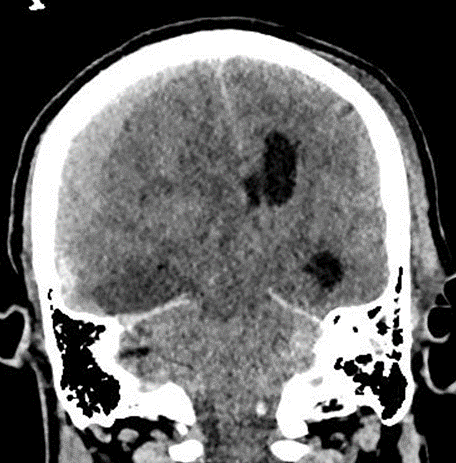 La mydriase / anisocorie en neuro-réa: ça vient d'où ? Ca veut dire ...