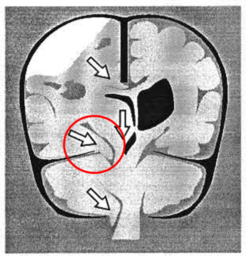La mydriase / anisocorie en neuro-réa: ça vient d'où ? Ca veut dire ...