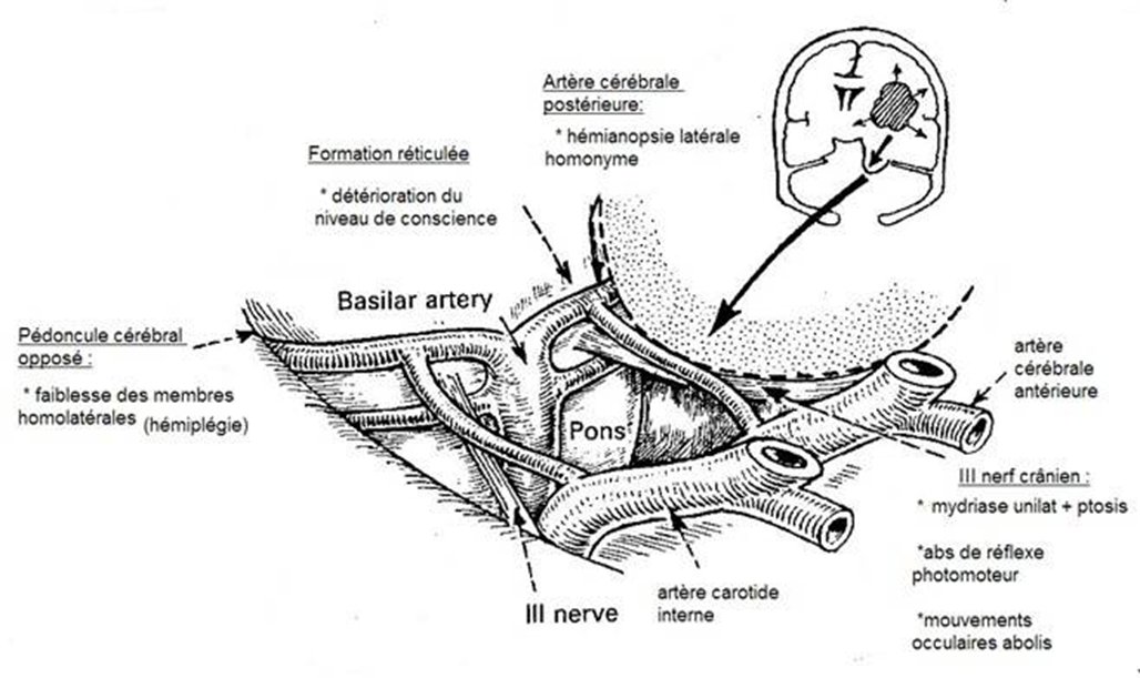 La mydriase / anisocorie en neuro-réa: ça vient d'où ? Ca veut dire ...
