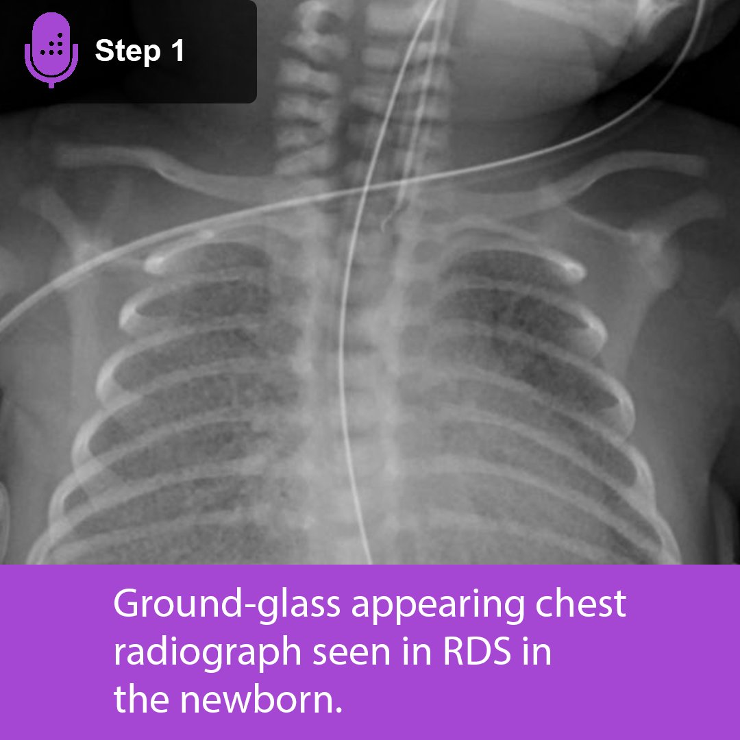 Respiratory Distress Syndrome Ground Glass