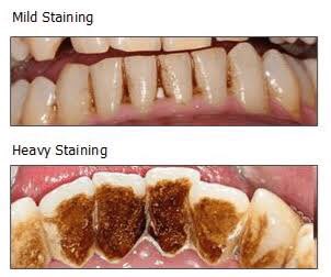 Coffee Stain Teeth