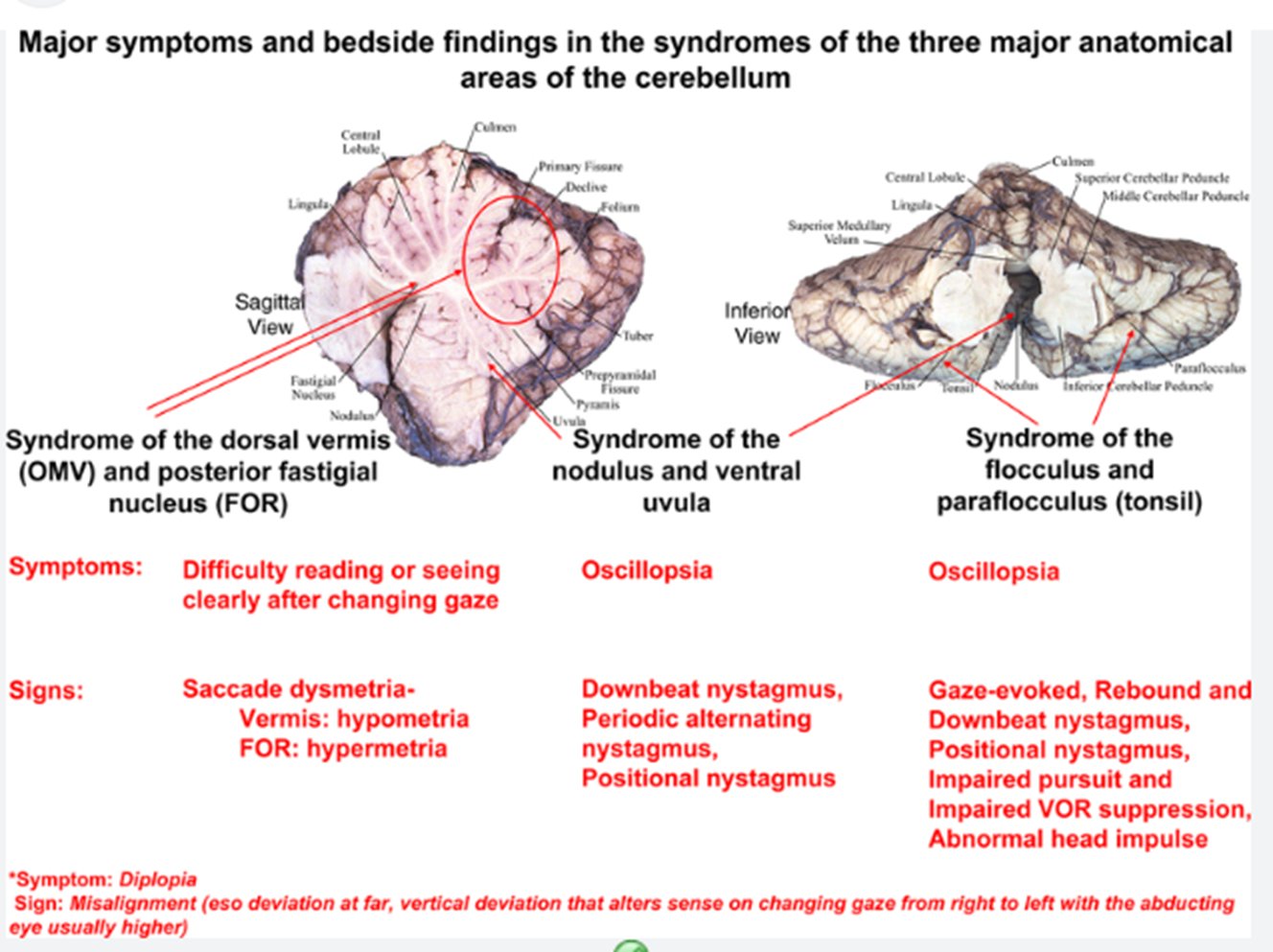 Flocculonodular Lobe Diagram
