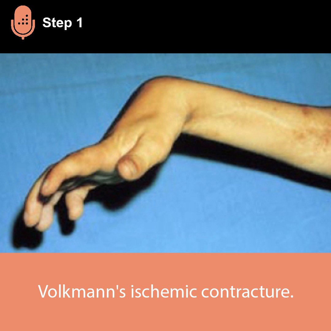 Volkmanns Ischemic Contracture