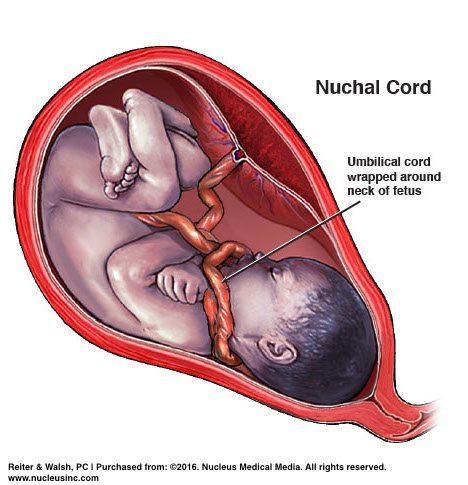 A nuchal cord happens when your baby’s umbilical cord becomes wrapped around their neck in the ...