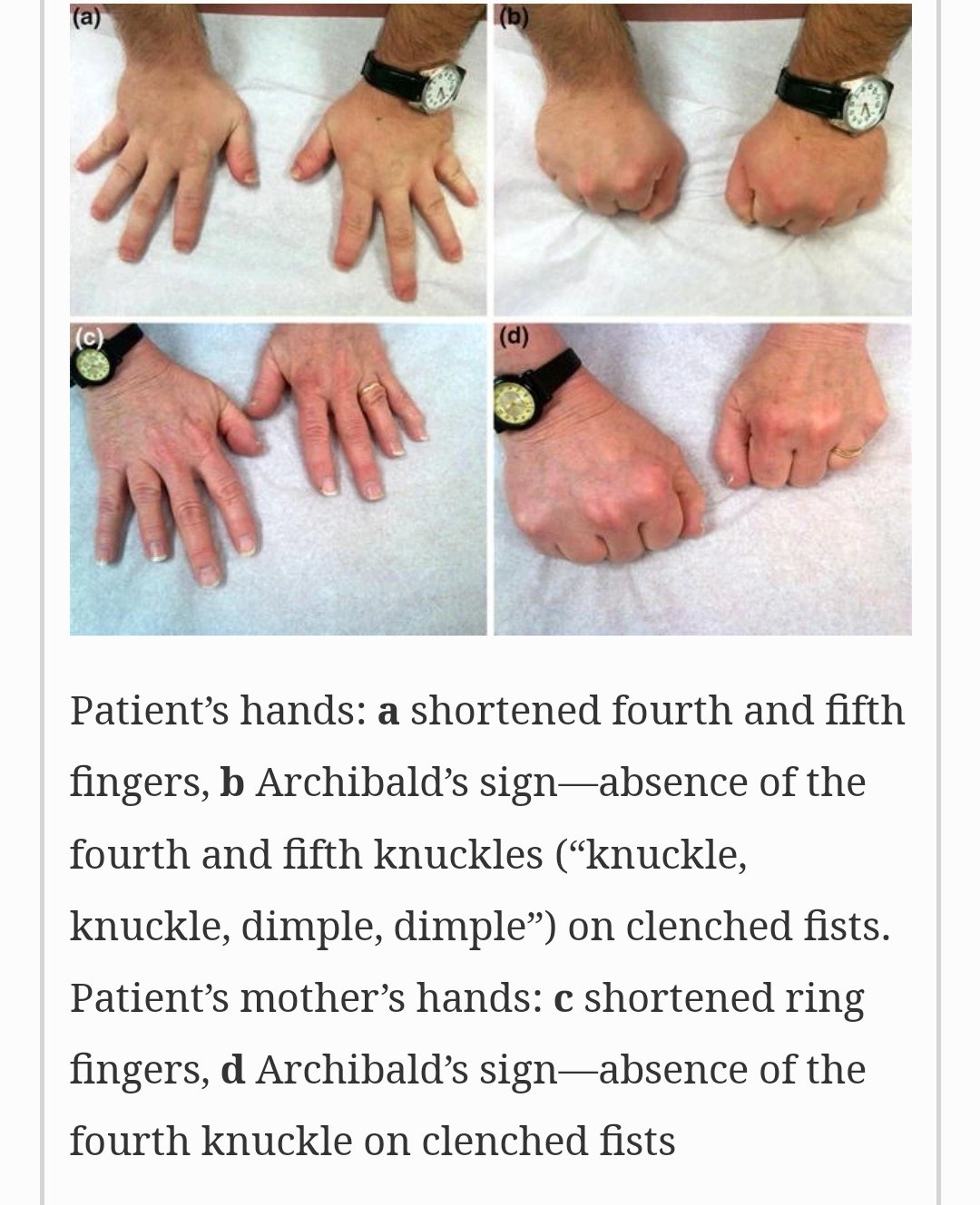 Knuckle Sign