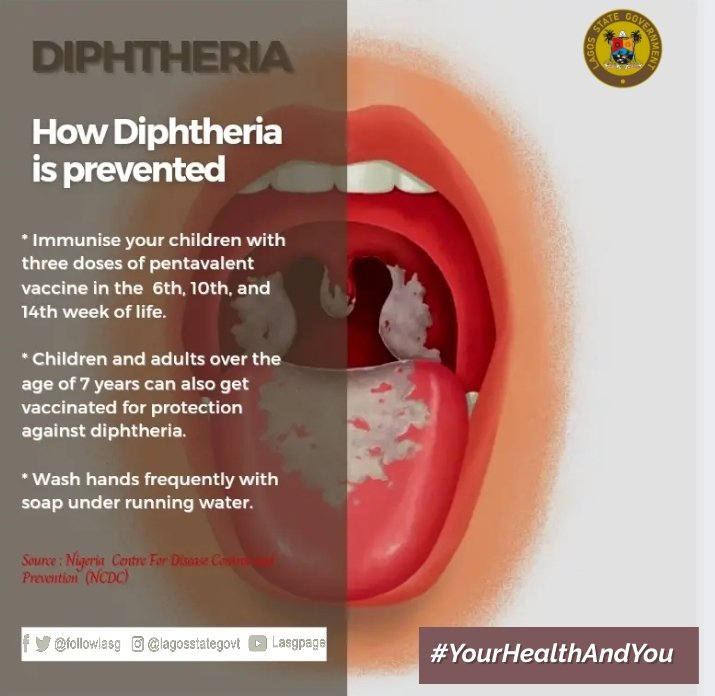 Diphtheria Symptoms In Adults