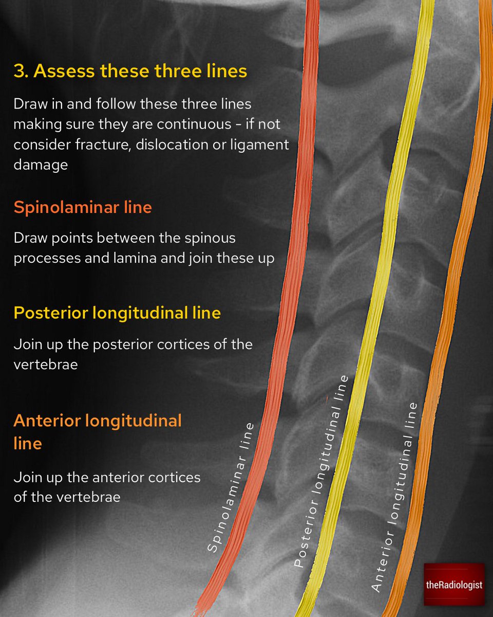 Although CT is first line in many countries X-Ray is still done in many ...