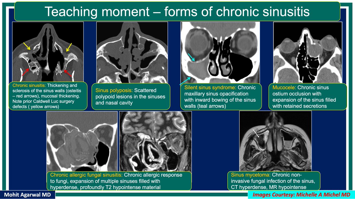 #MCWNeuroradBTW 096 Ans: Osteitis Check out #TeachingMoment on Chronic ...