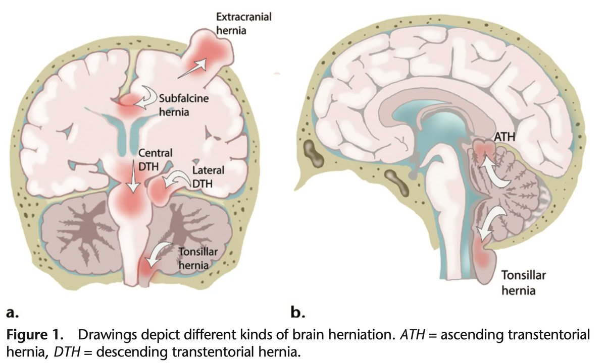 Radiologia De Hernia Tonsilar Chiari Malformations: A Review Of The