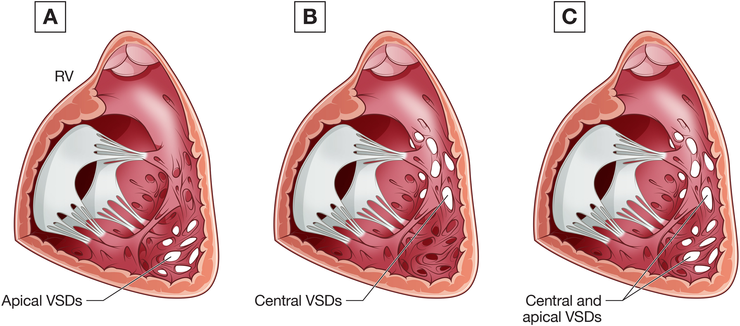 Ventricular Septal Defect Types