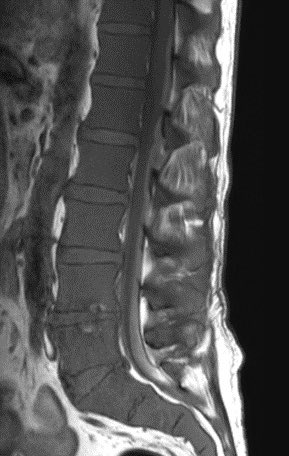 Case of diffusely hypointense marrow on T1 in this patient with ...