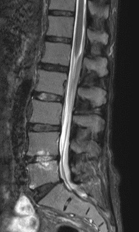 Case of diffusely hypointense marrow on T1 in this patient with ...