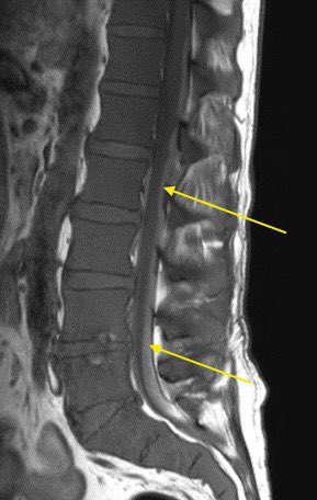 Case of diffusely hypointense marrow on T1 in this patient with ...