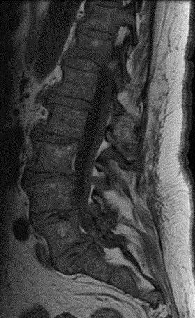 Case of diffusely hypointense marrow on T1 in this patient with ...