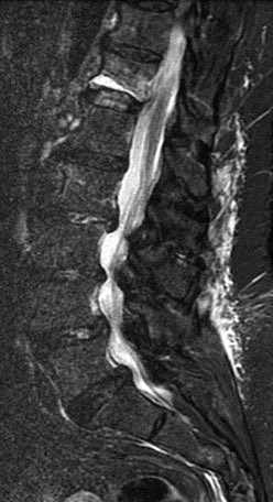 Case of diffusely hypointense marrow on T1 in this patient with ...