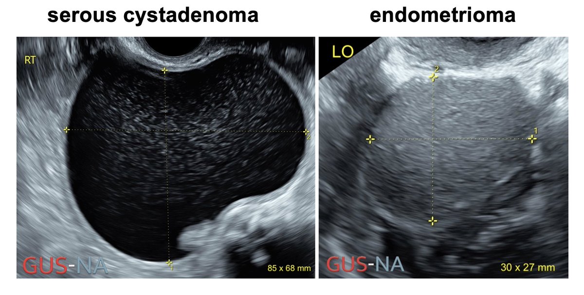 Gynecologic Ultrasound Society Of North America On Twitter Correct