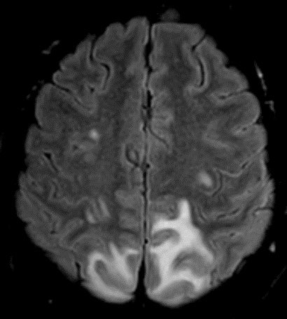 Posterior reversible encephalopathy syndrome (PRES) in this patient ...