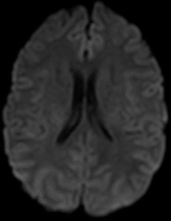 Posterior reversible encephalopathy syndrome (PRES) in this patient ...