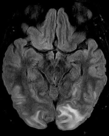Posterior reversible encephalopathy syndrome (PRES) in this patient ...