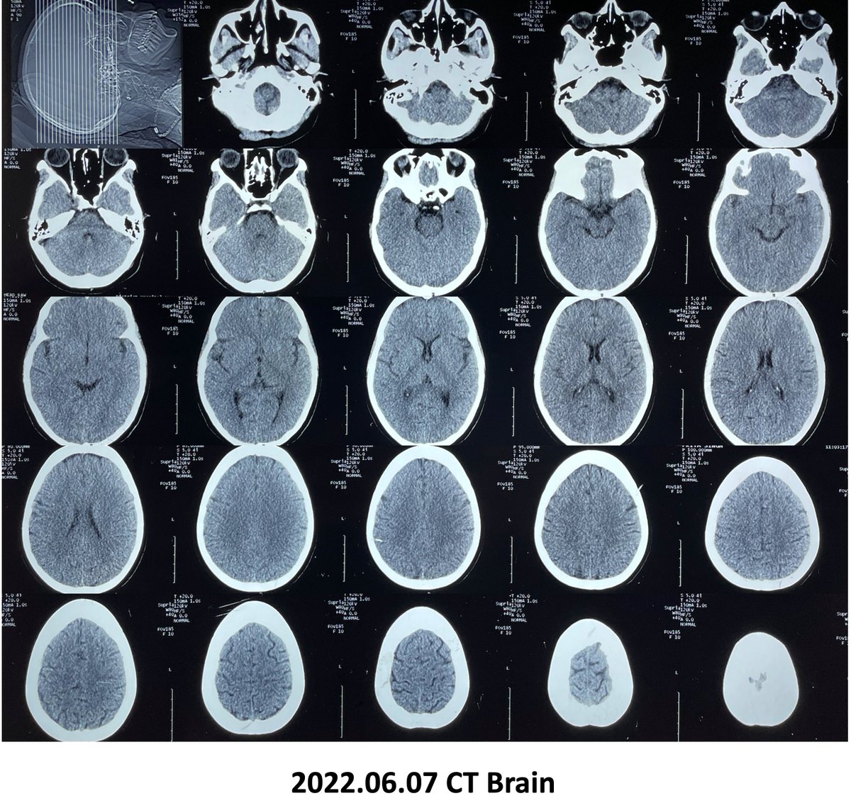 (1/12) Another interesting case. 26F. LUCS 2 days earlier 👉🏾 Headache ...