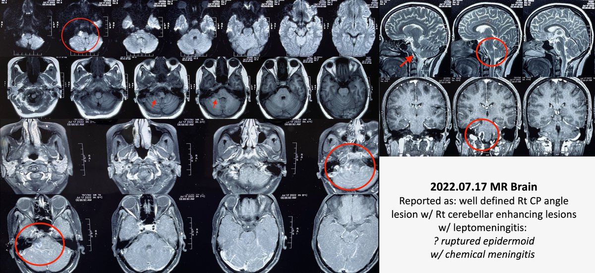(1/12) Another interesting case. 26F. LUCS 2 days earlier 👉🏾 Headache ...