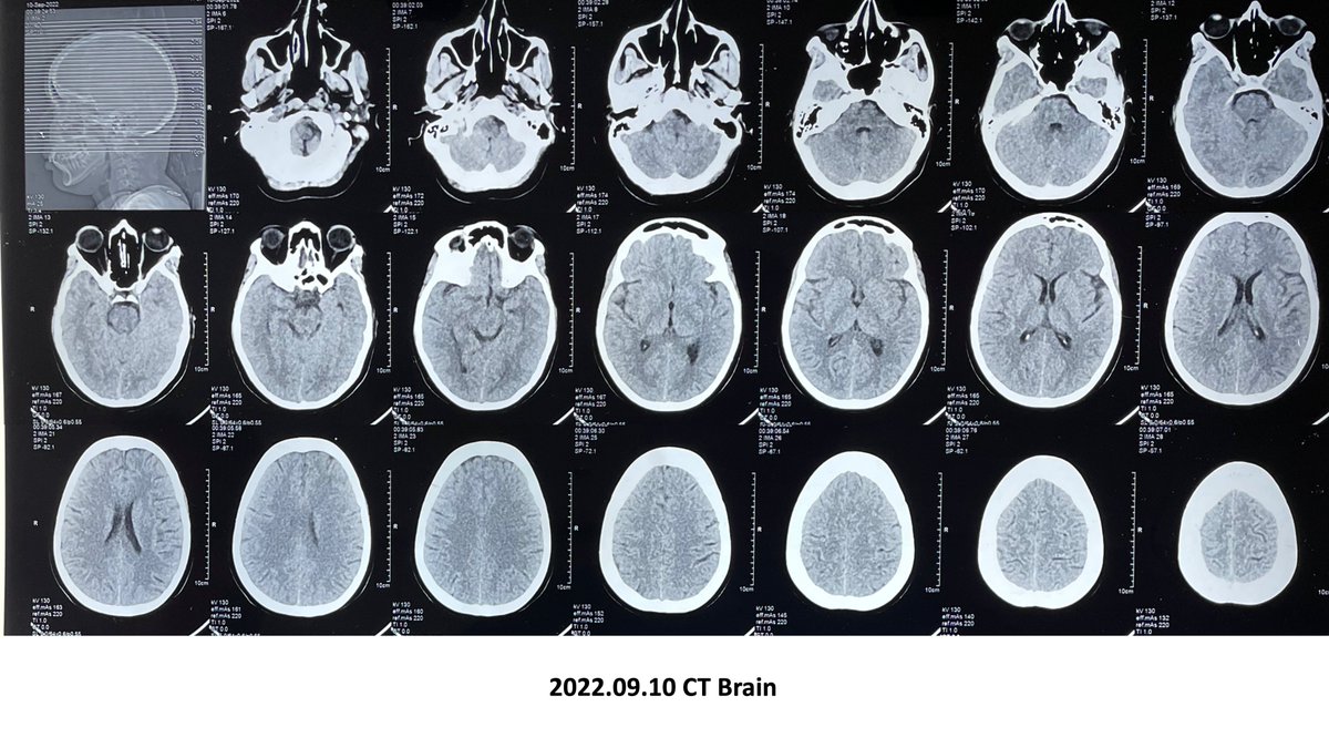 (1/12) Another interesting case. 26F. LUCS 2 days earlier 👉🏾 Headache ...