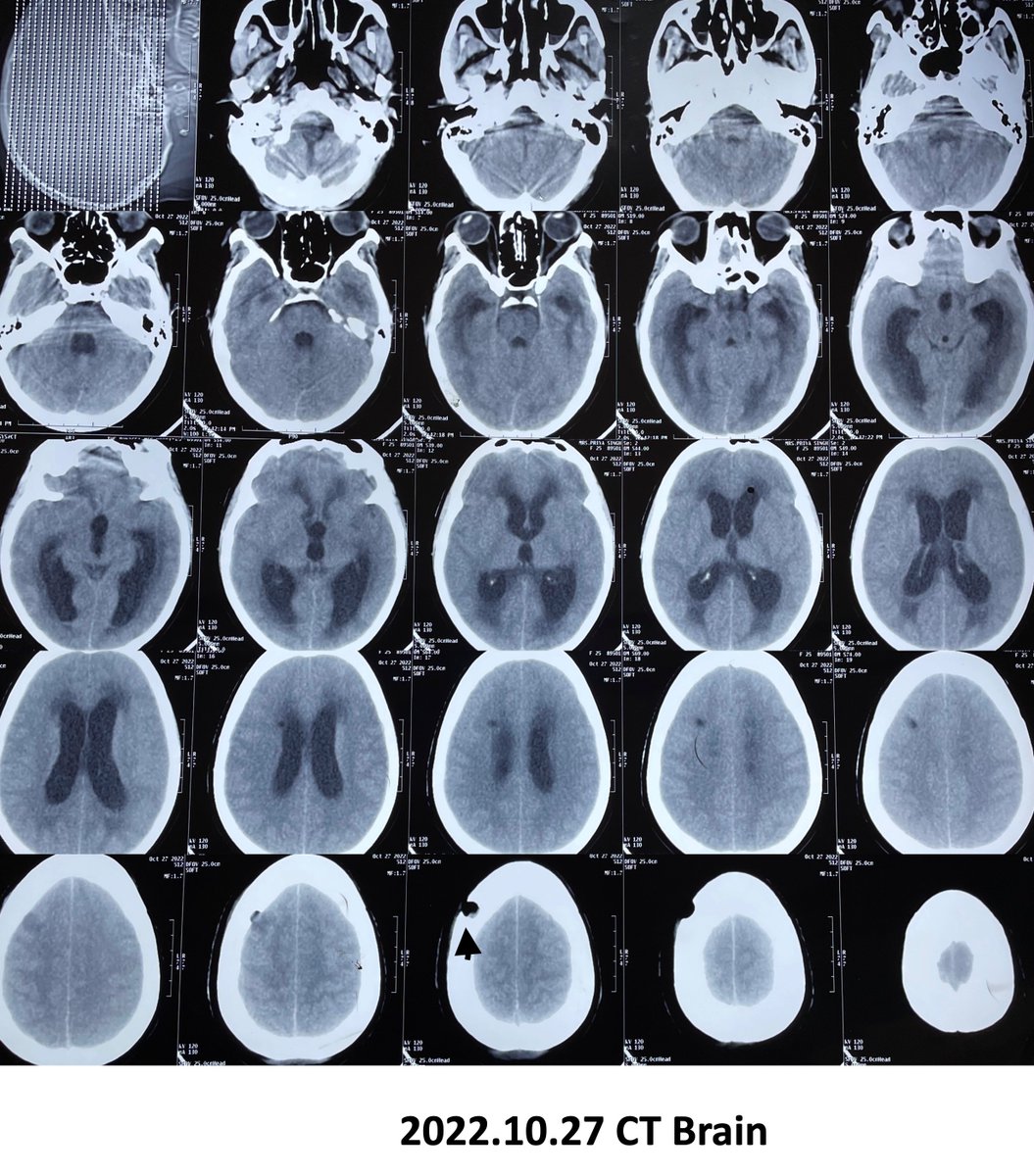 (1/12) Another interesting case. 26F. LUCS 2 days earlier 👉🏾 Headache ...