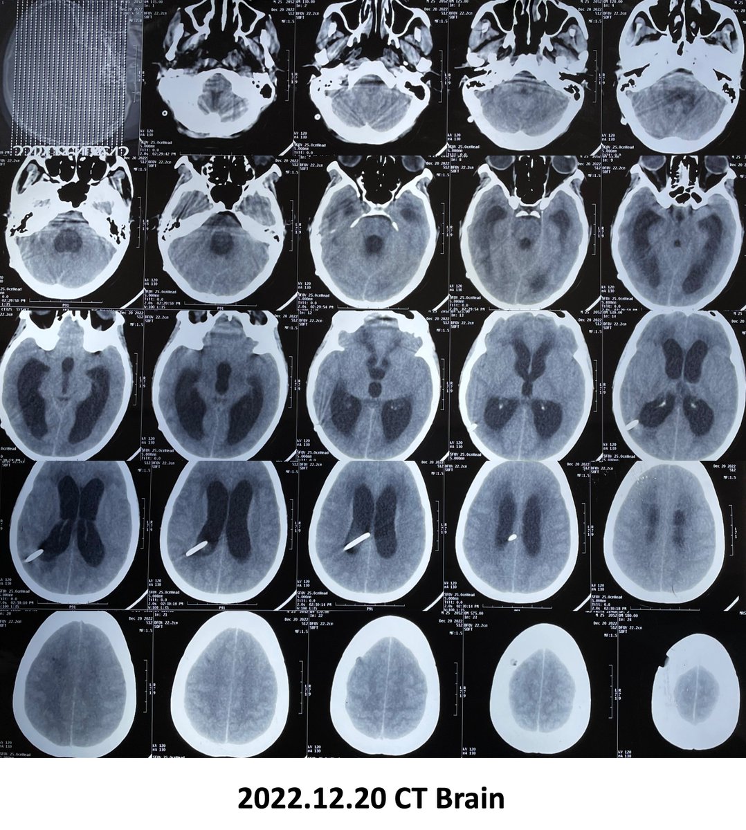 (1/12) Another interesting case. 26F. LUCS 2 days earlier 👉🏾 Headache ...