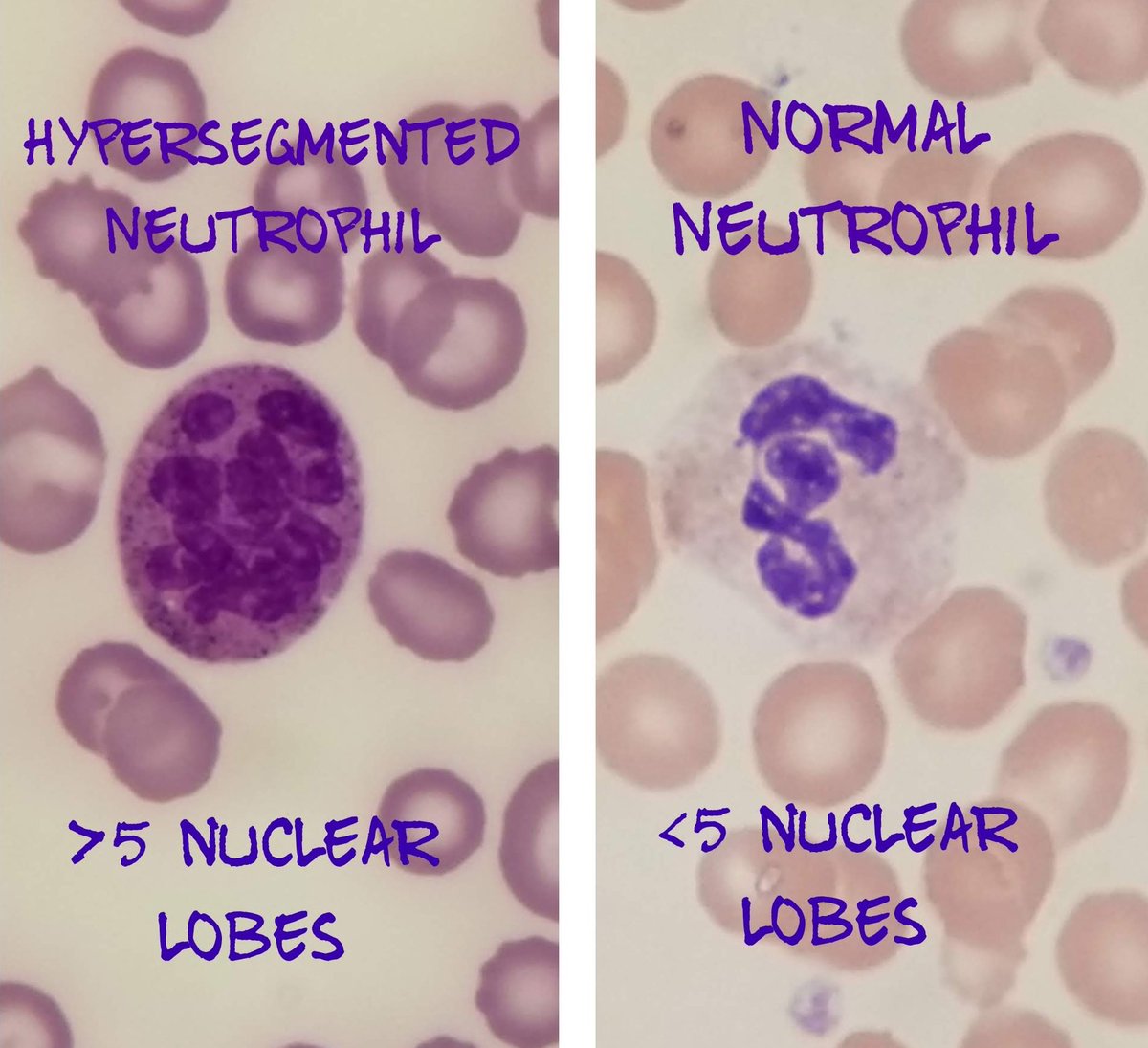 هل من السهل أن يصاب الشخص Vitamin B12 Deficiency أو Folate Deficiency ...