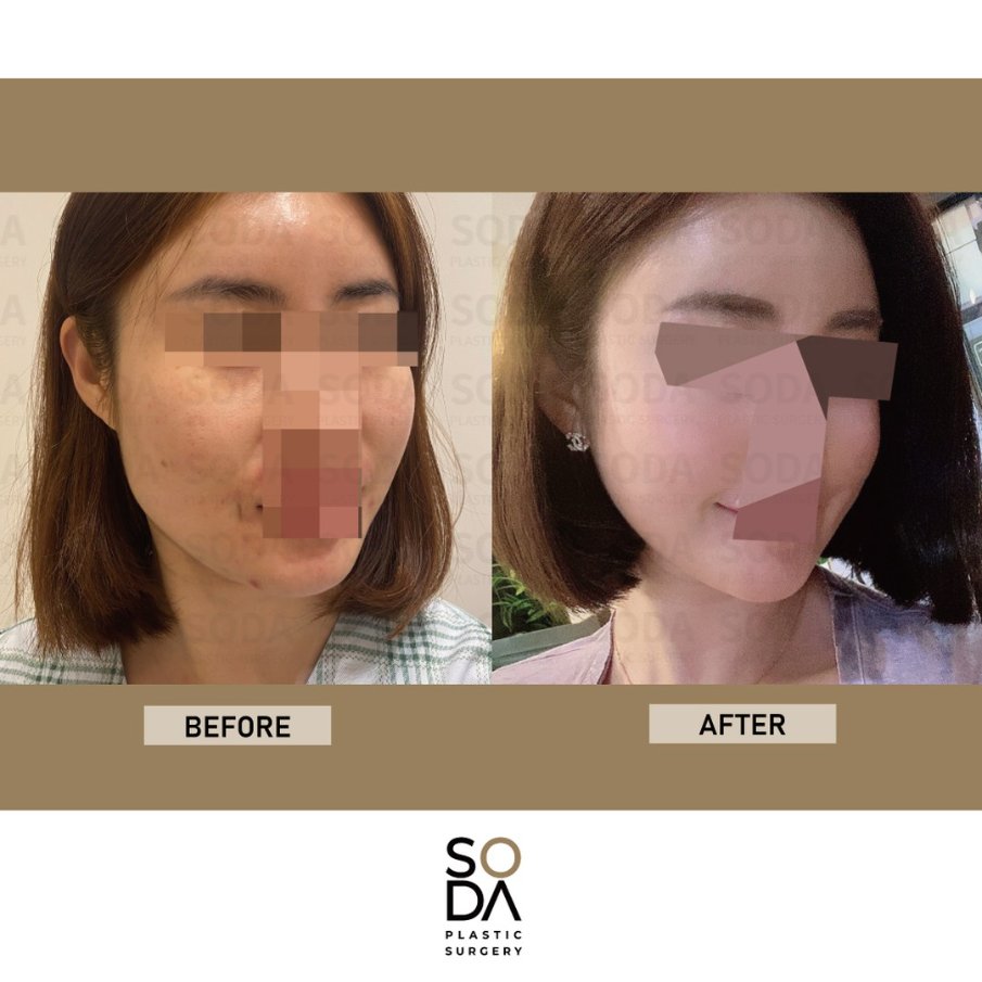 ナビコリア🍀 韓国美容整形🇰🇷 無料サポート 2008年から~ on Twitter: "SODA美容外科🌟 エラ+頬骨縮小前後写真 ️東京相談会 2月25日:空き無し😭 2月26日:3席のみ ...