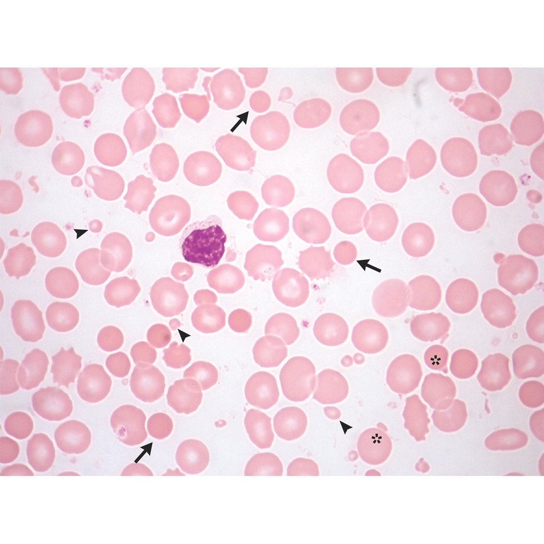 Spherocytosis Smear