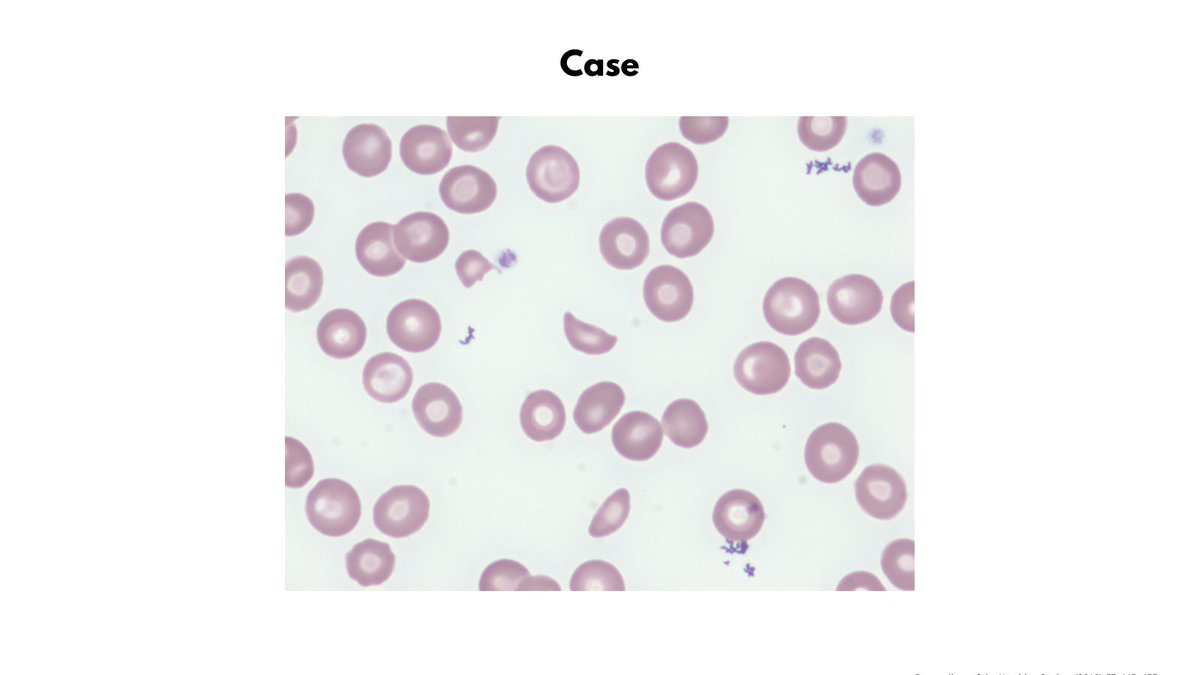 CASE STUDY 1/11 74 yo F presents with CBC shown in graphic below. You ...