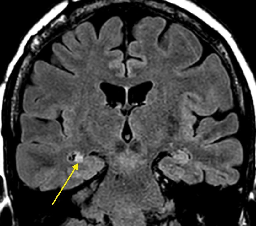 Mesial Temporal Sclerosis (MTS) in this patient with temporal lobe ...