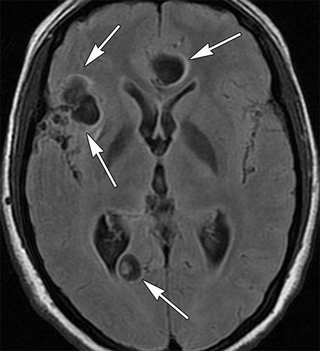 Radrounds Radiology Network On Twitter Patient With Elevated Ige And