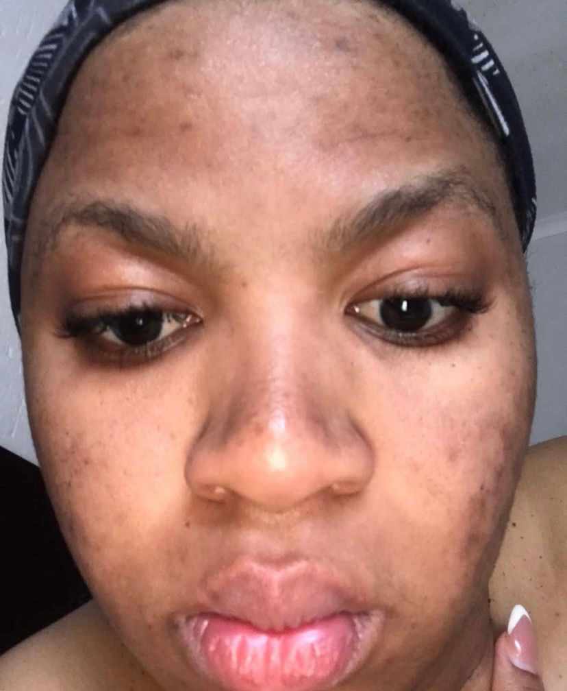 Msakasaka⛔®️ on Twitter: "Ur not agly u only hv a bad skin 😀"