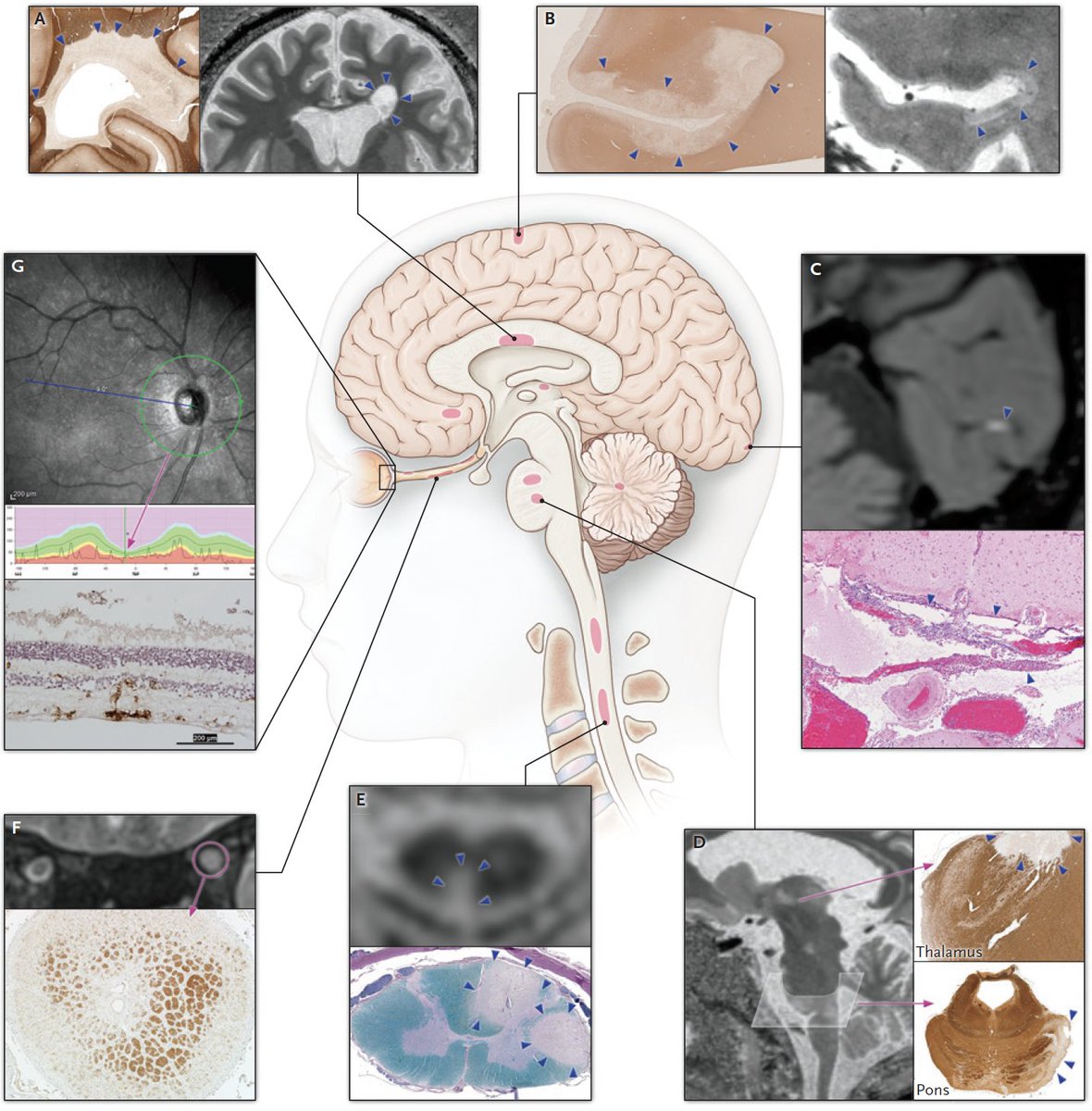 The Innovation | Medicine on Twitter: "Multiple sclerosis (MS) is a ...